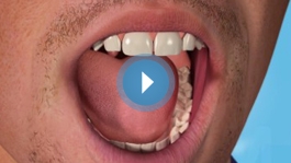 White Fillings St Leonards on Sea - Harrow Lane Dental Practice ...